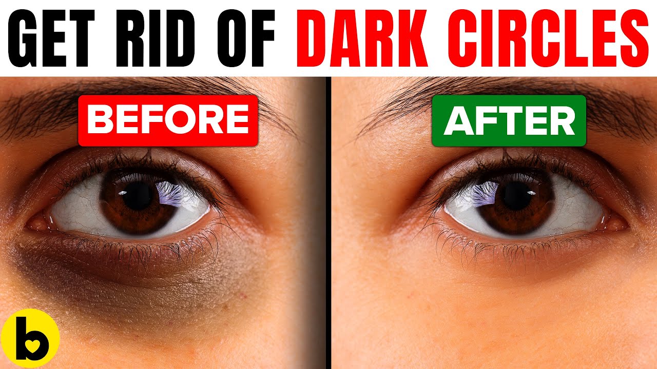 Get Rid Of Dark Circles Permanently With These 8 Effective Tips - YouTube