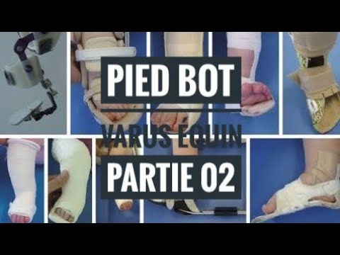 Pied Bot Varus Équin Congénital - partie 02 - YouTube
