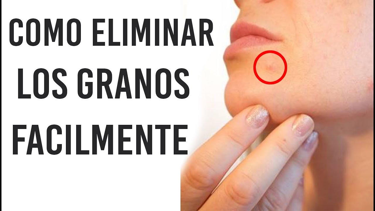 ELIMINA LOS GRANOS CIEGOS RAPIDÍSIMO PASO A PASO Sin Dejar Marcas En La ...