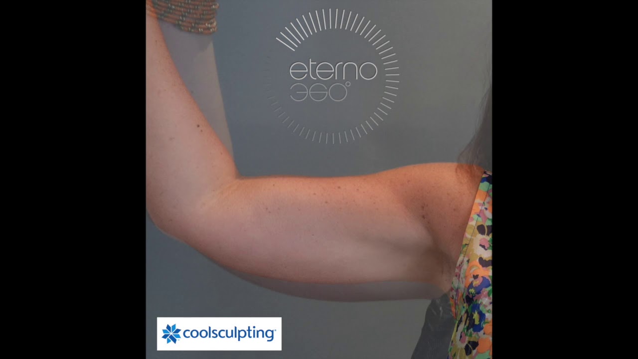 Coolsculpting to arms - YouTube