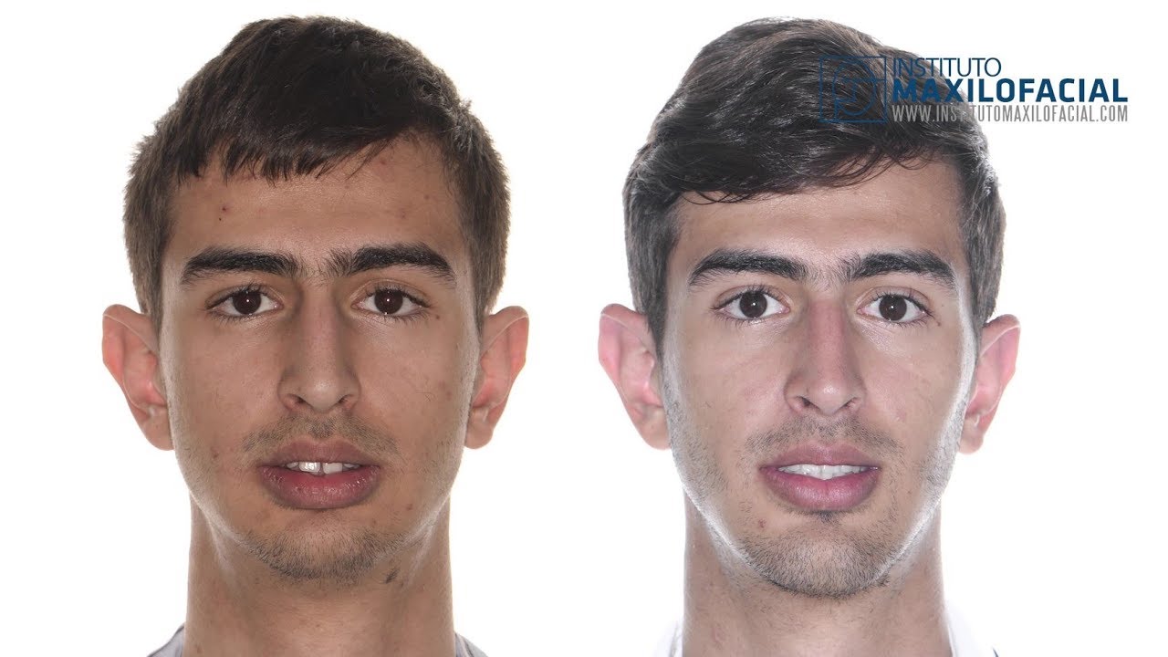 Bimaxillary orthognathic surgery. Case #60: Andrés- Class 2, overbite ...