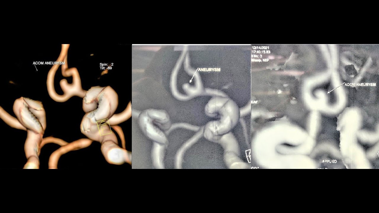ACOM-A ANTERIOR COMMUNICATING ARTERY ANEURYSM MICROSURGICAL CLIPPING-dr ...
