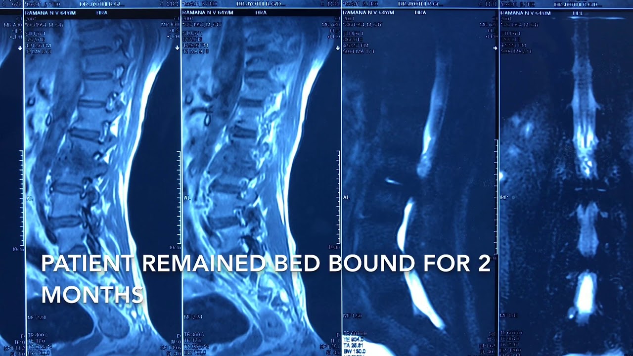 L2-3 Discitis - YouTube