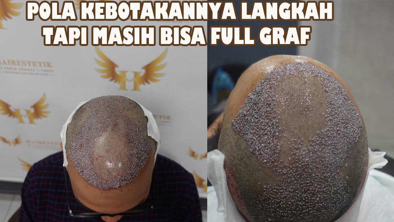 hair transplant tanam rambut turki, pola kebotakan yang tidak umum jadi ...
