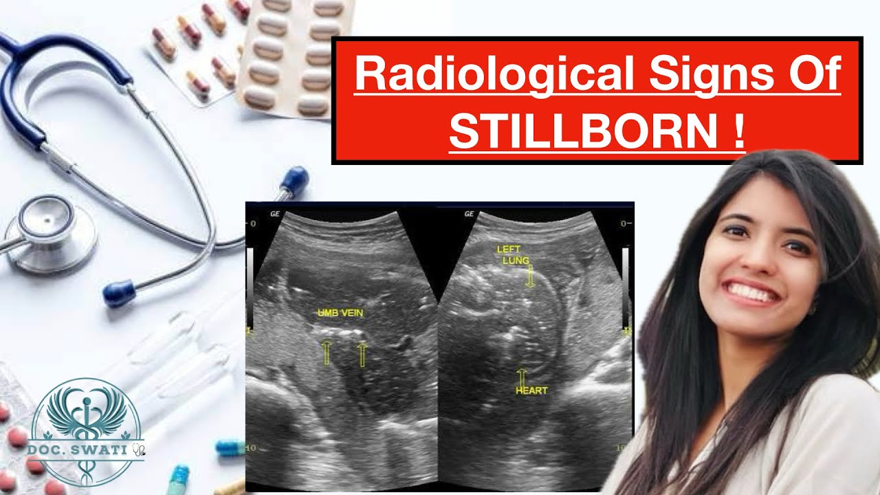 Radiological Signs Of STILLBORN ! STILBIRTH - YouTube