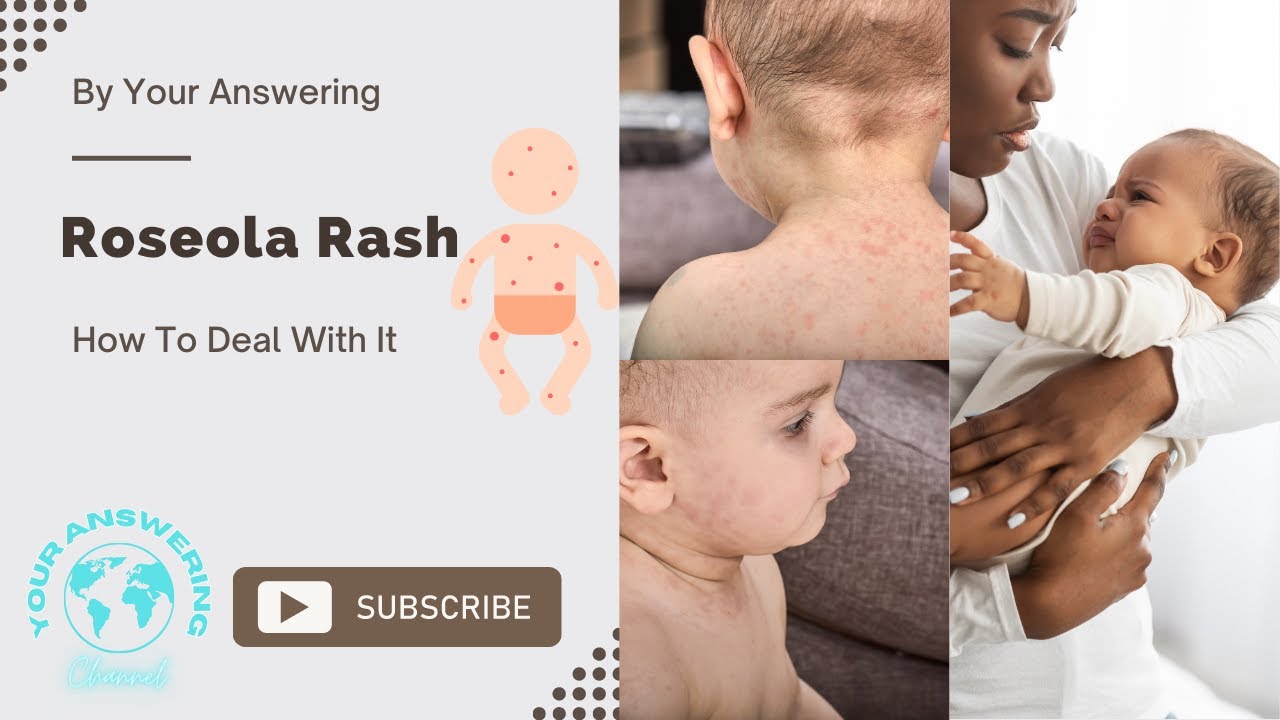 Roseola Rash Babies and How to Treat with Home Remedies! - YouTube
