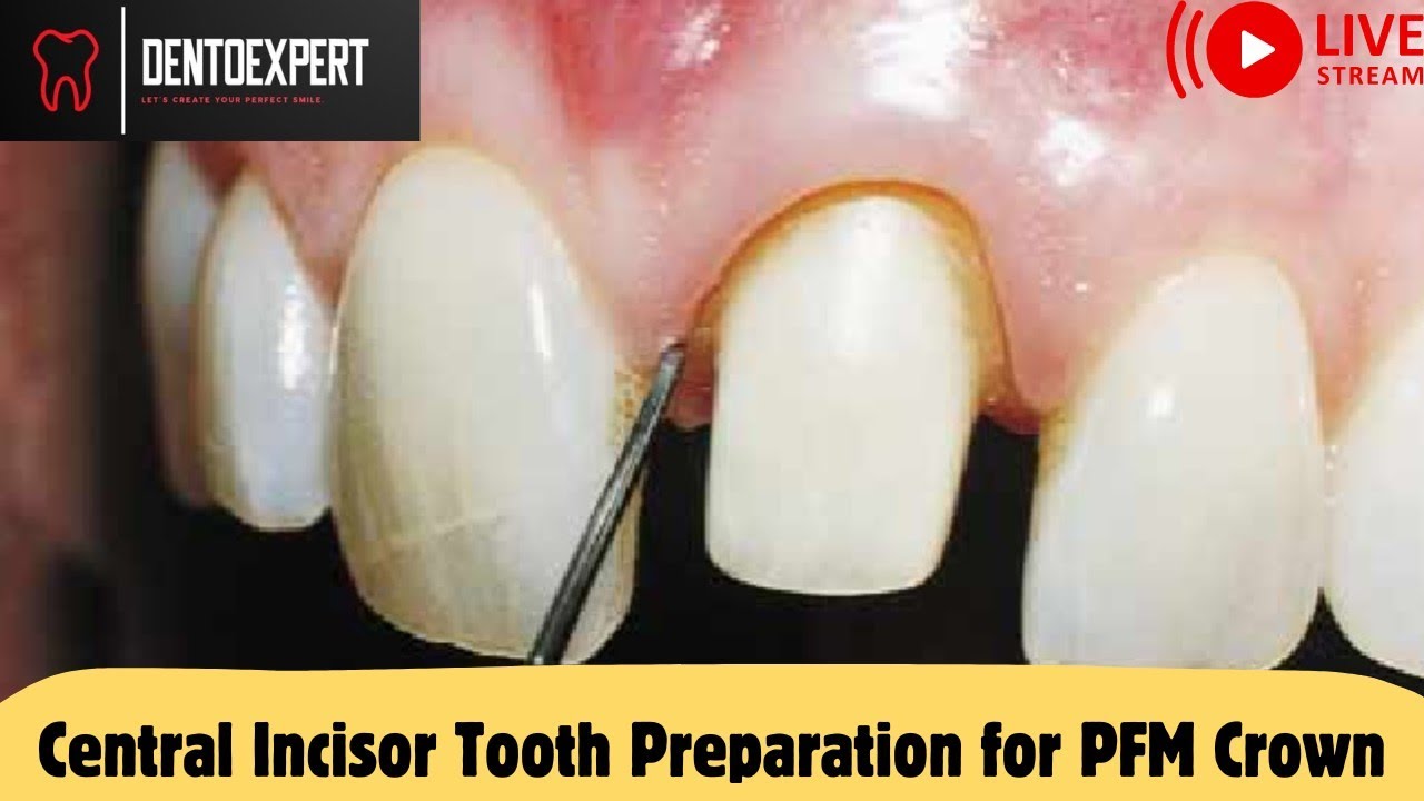 maxillary Anterior crown cutting Part 2 - YouTube