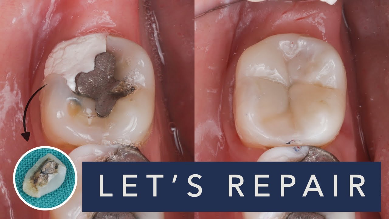 Filling Replacement: Composite filling on the last molar - YouTube