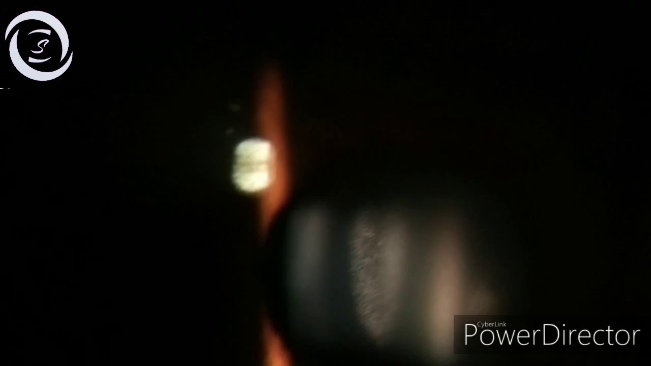 How to master direct illumination technique and blue dot cataract - YouTube