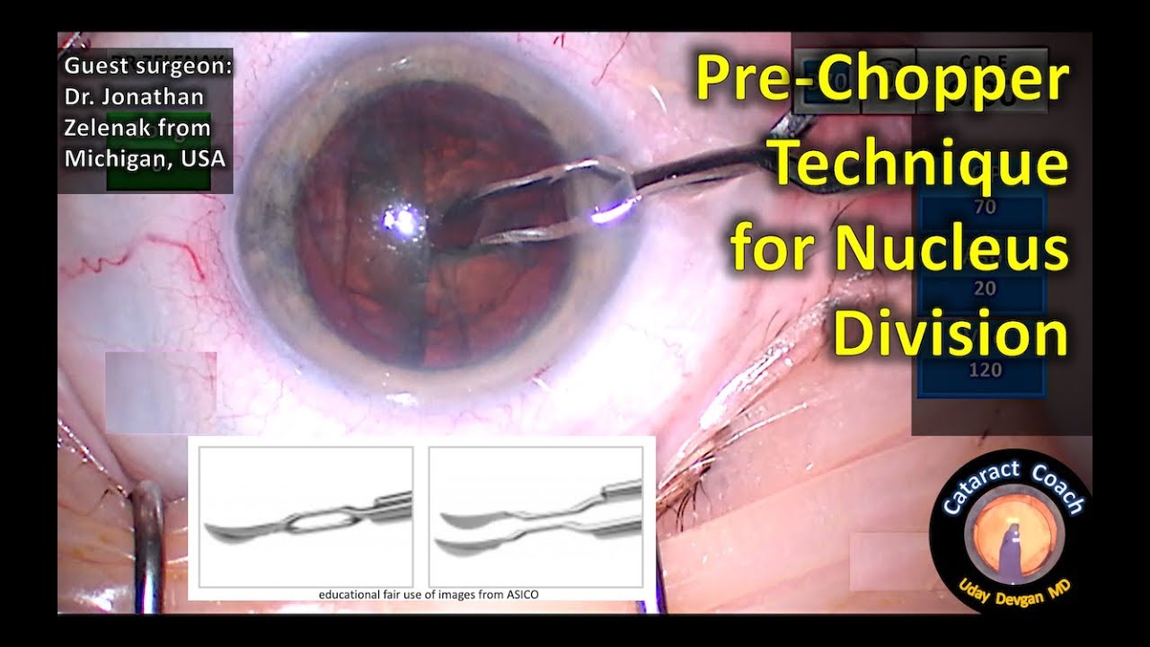 Pre-Chopper technique for nucleus division in cataract surgery - YouTube