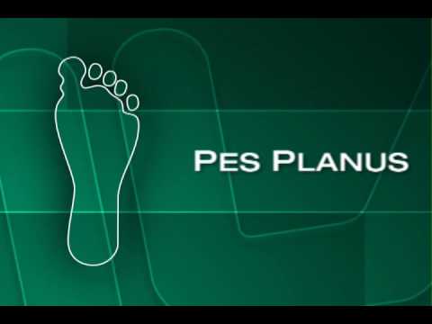 Foot Type: Pes Planus (Flat Arch)