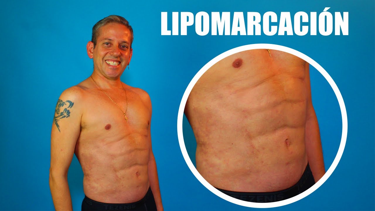 LIPOMARCACIÓN: Se hizo el CUERPO PERFECTO 🩲 Lipo HD o Marcación ...