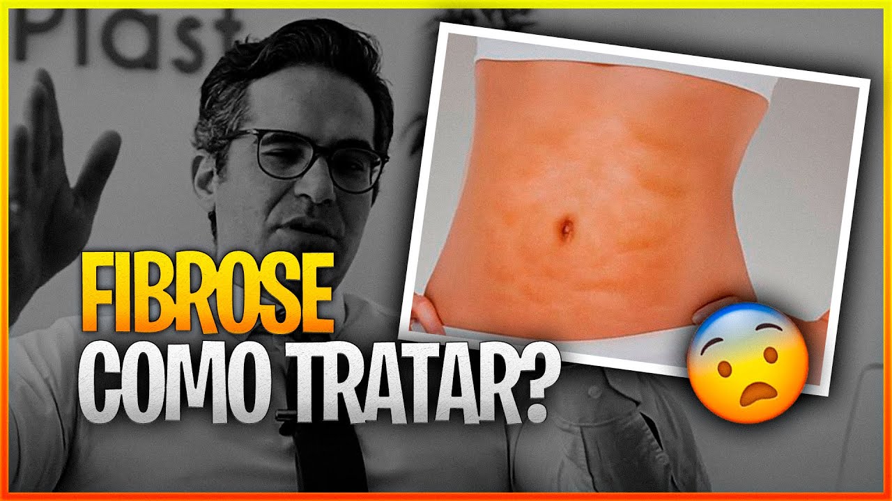 COMO TRATAR A FIBROSE APÓS LIPOASPIRAÇÃO? 😨 - YouTube