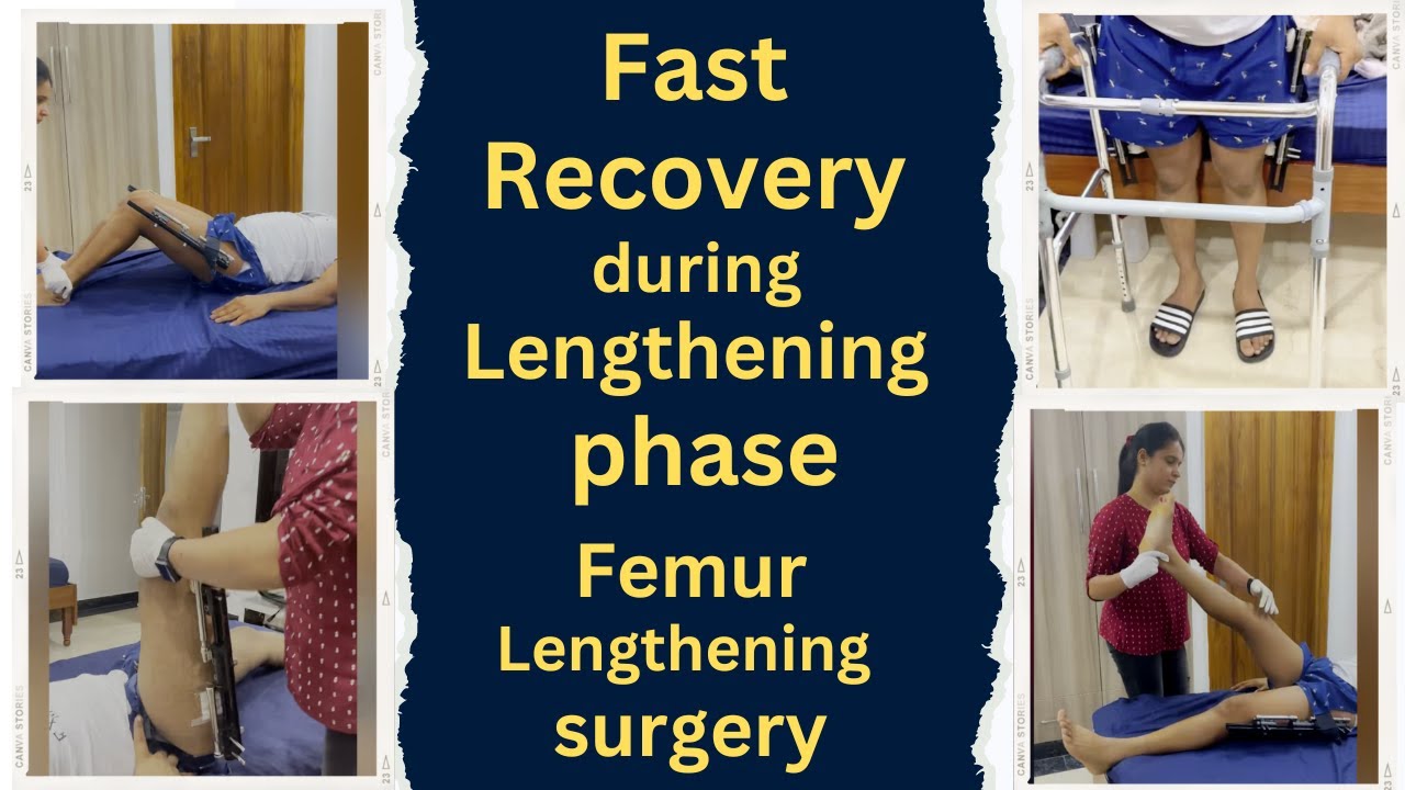 Fast Recovery during Lengthening phase - Femur Limb Lengthening surgery ...