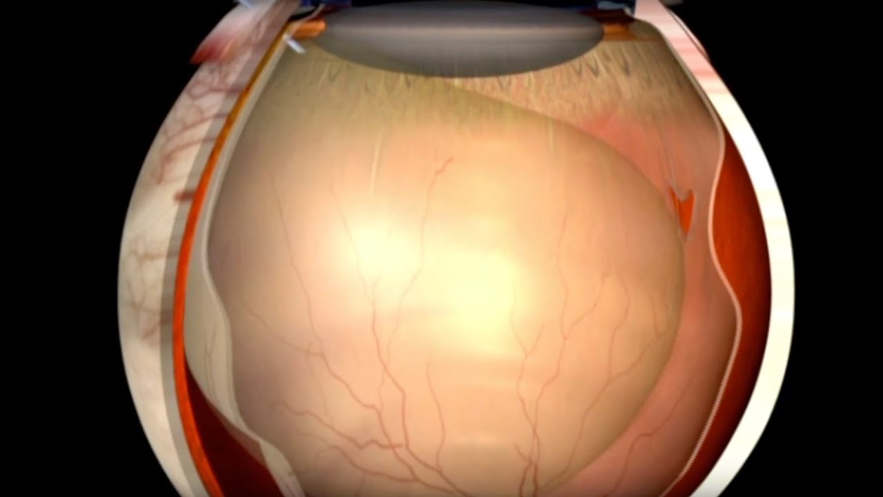 Retina Desprendida Retinopexia Neumática - YouTube
