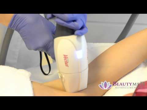 depilacja laserem diodowym Vectus w Klinice BeautymeD - rekomenduje Kaja Paschalska