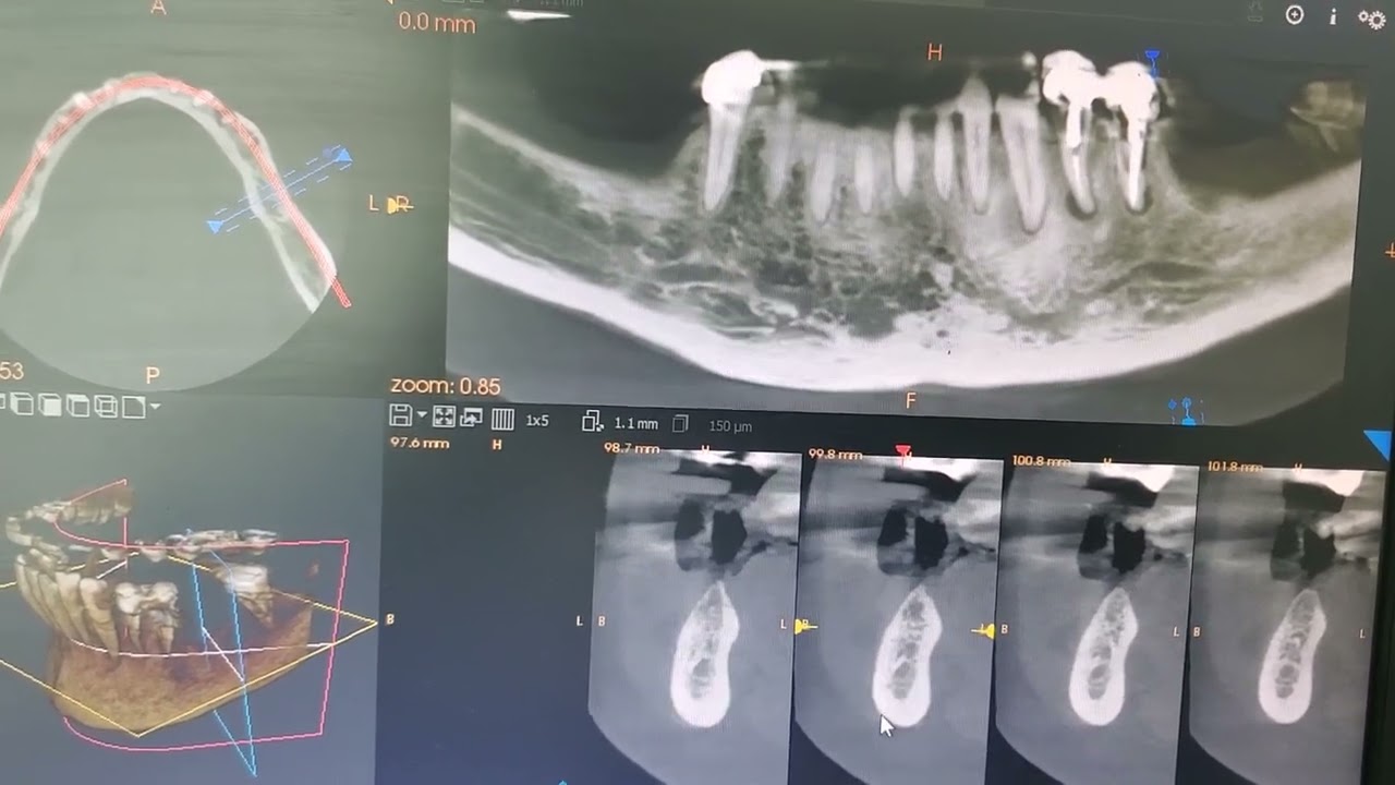 فيديو يتناول عملية "فسخ العظم" أو bone splitting باستخدام البييزو piezo surgery - YouTube