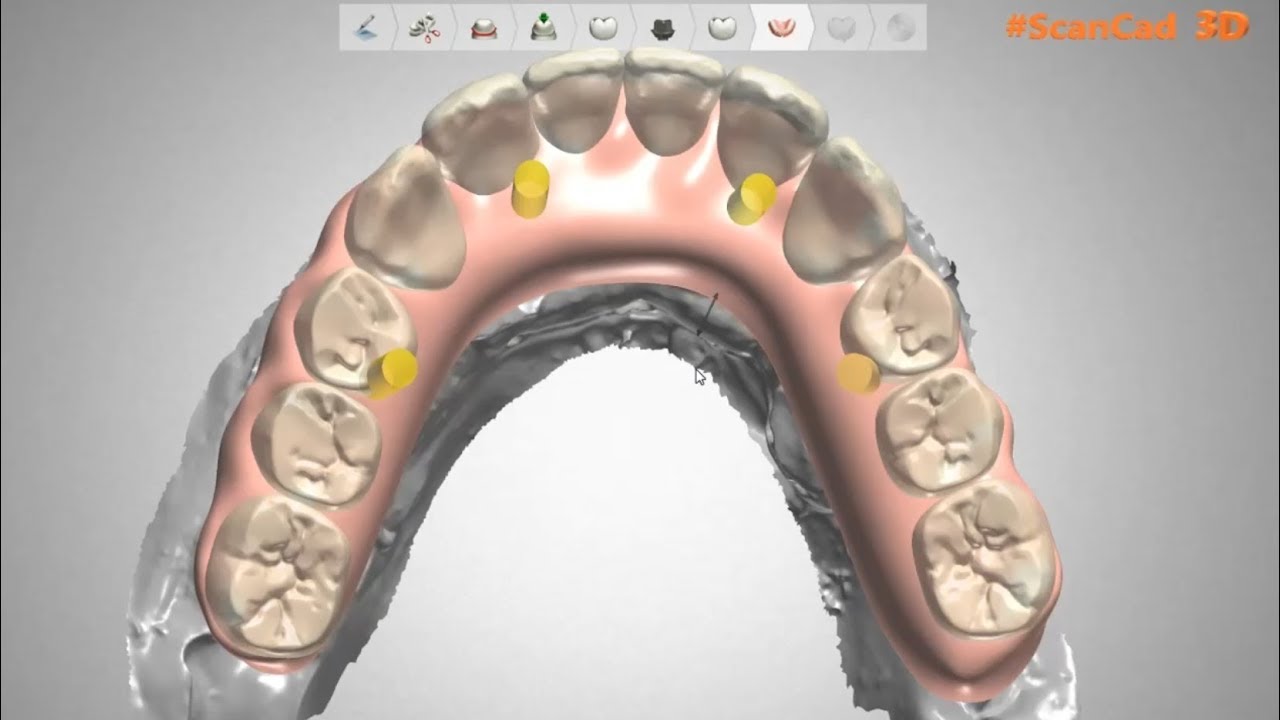 Fast 3shape gingiva - YouTube