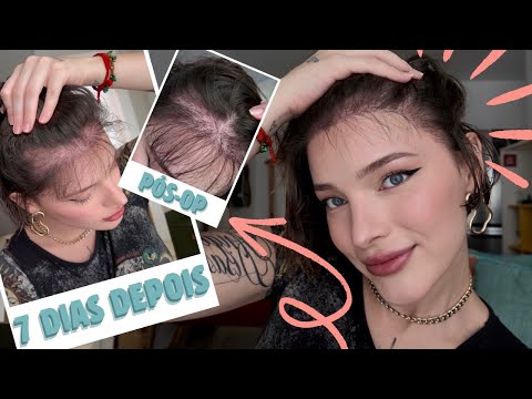 1ª SEMANA DE PÓS OPERATÓRIO | Transplante Capilar: Lavagem, Cuidados & Dúvidas 