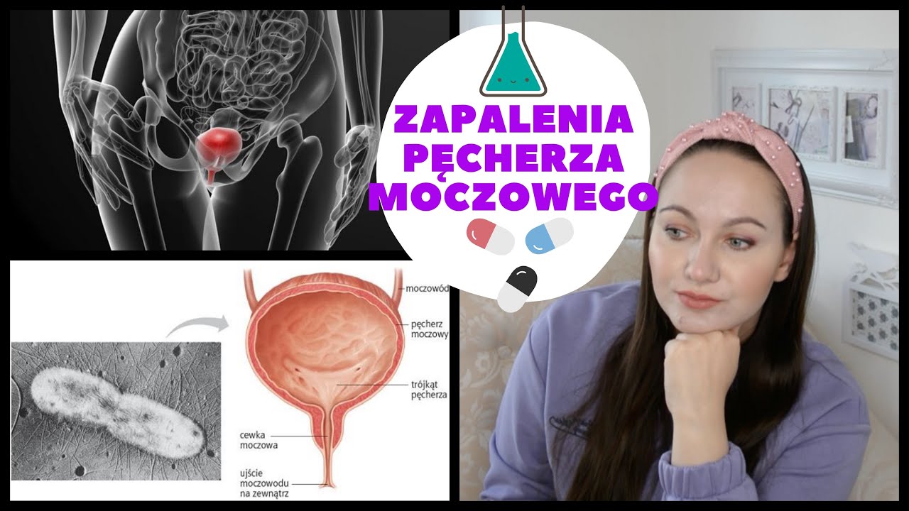 ZAPALENIE PĘCHERZA MOCZOWEGO| Nawracające co kilka miesięcy - YouTube