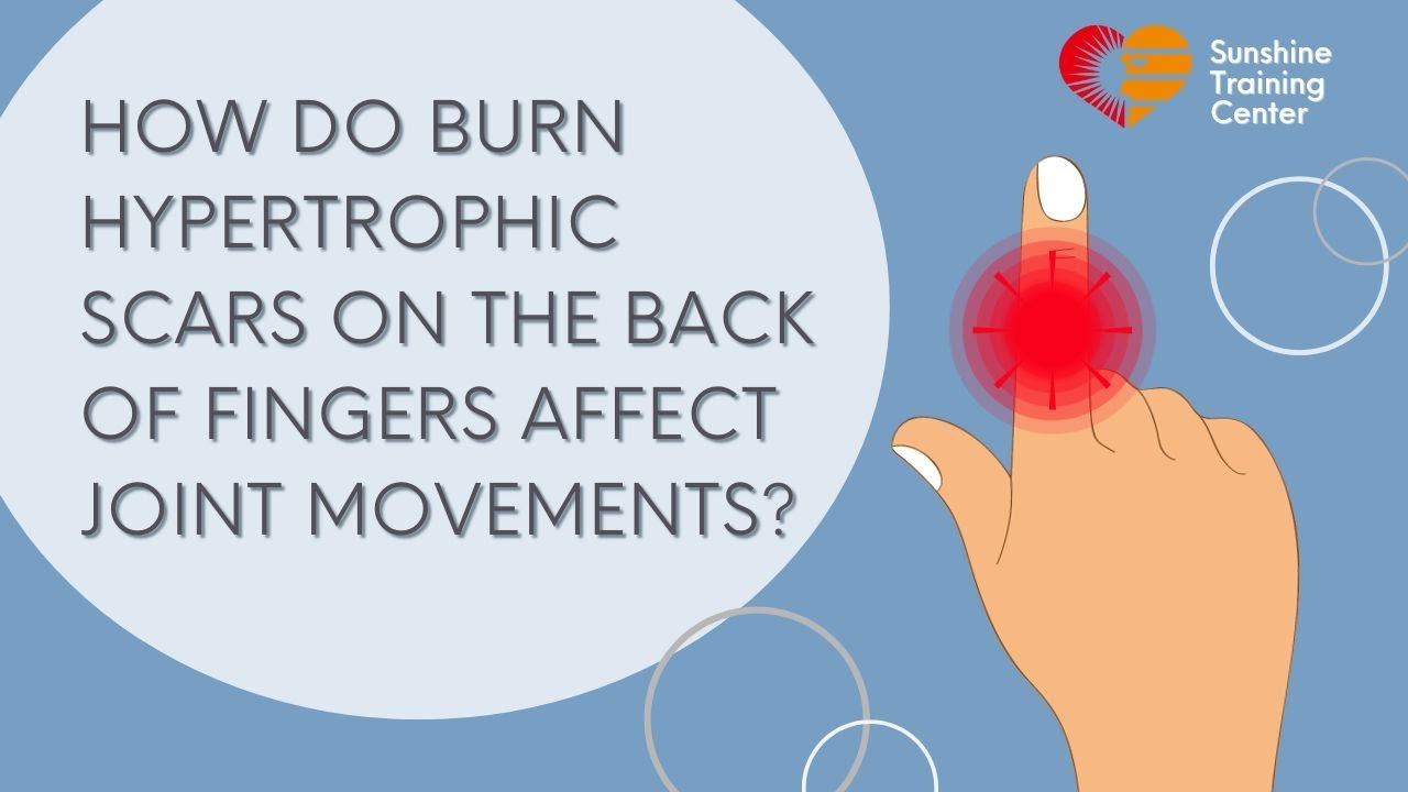 How do burn hypertrophic scars on the back of fingers affect joint ...