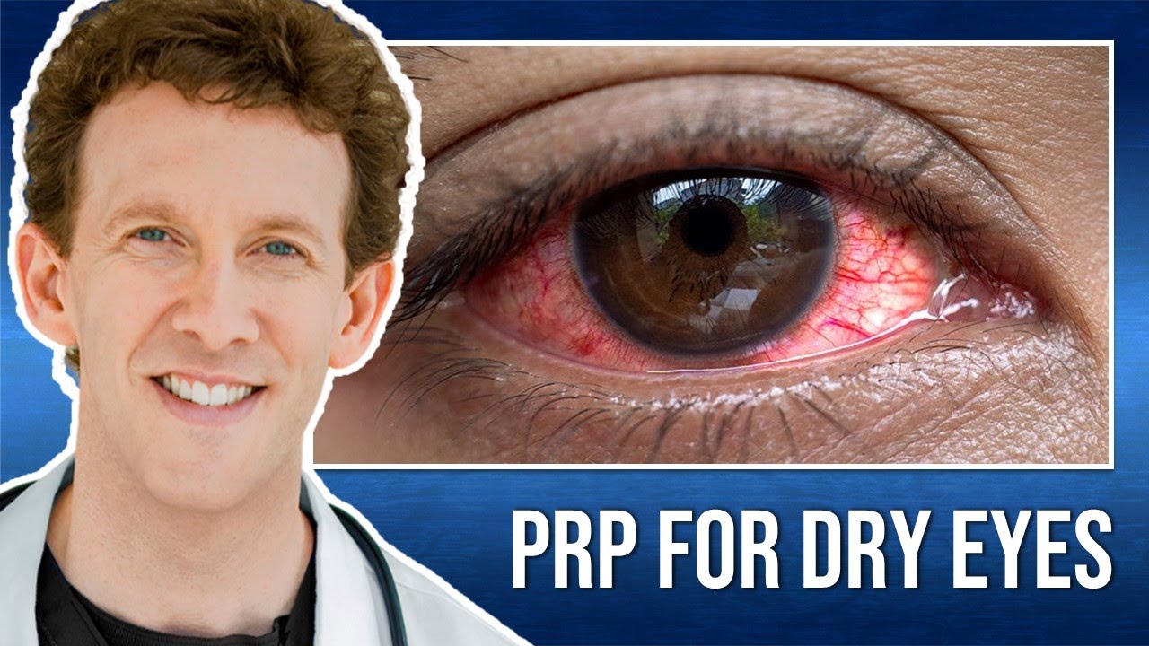 PRP Treatment for Dry Eyes with Dr. Scheiner | Kara's Testimonial - YouTube