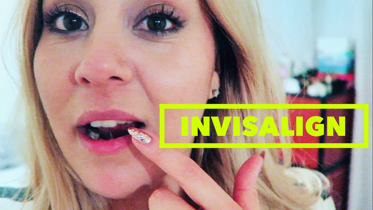 I got Invisalign - YouTube