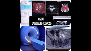MRI Female pelvis planning and positioning | Doovi