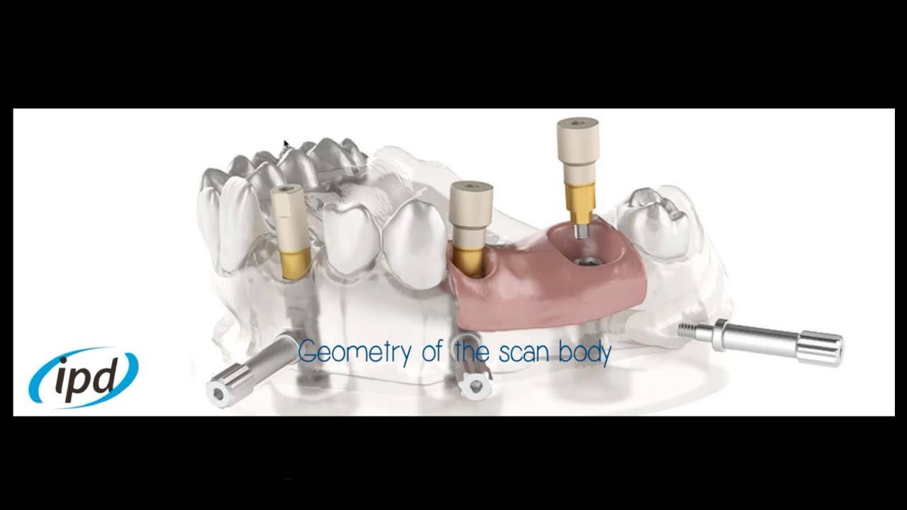 WEBINAR: Workflow digital prótesis sobre implantes con Scanbody IPD y ...