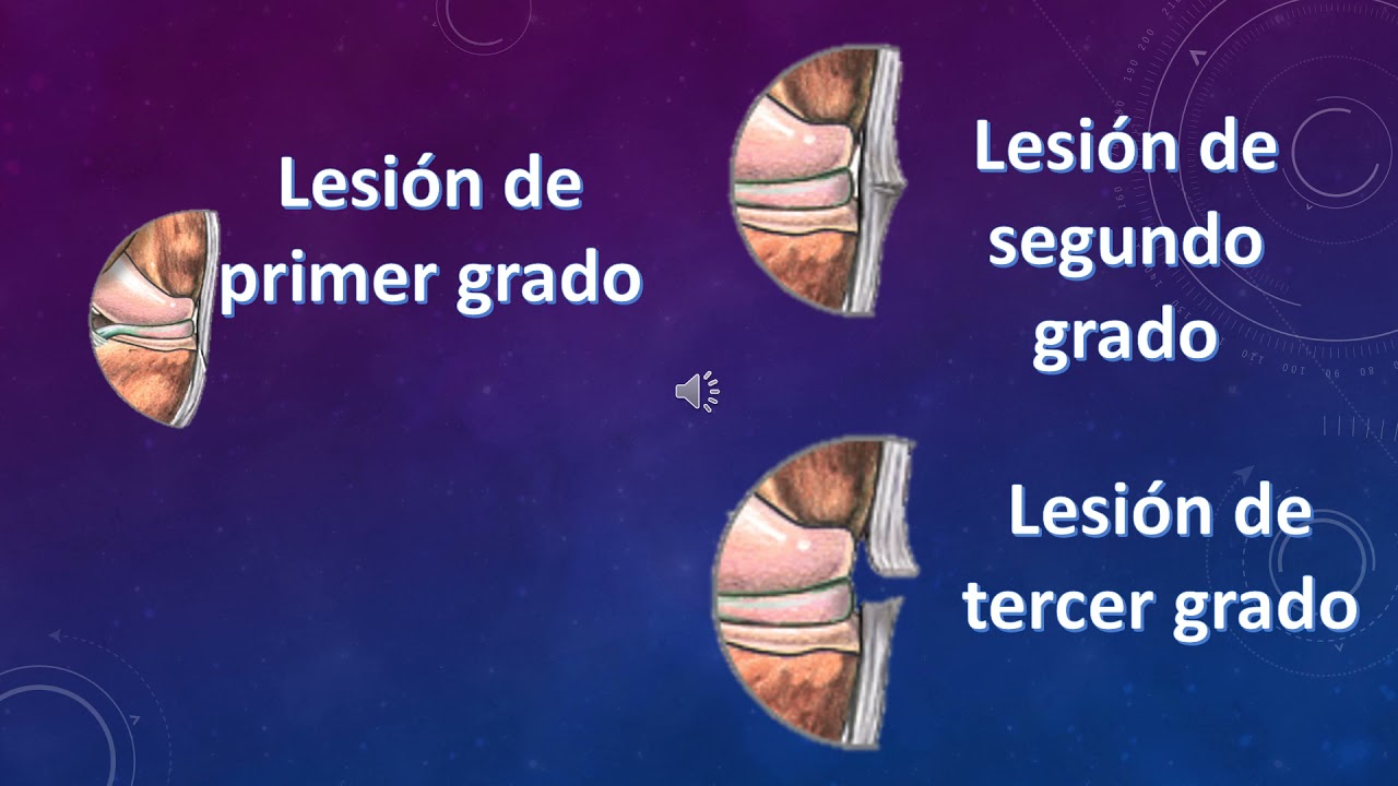 LESION DEL LIGAMENTO COLATERAL MEDIAL DE LA RODILLA - YouTube