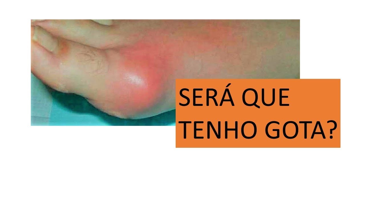 A DOR AGUDA NO PÉ pode ser gota. - YouTube