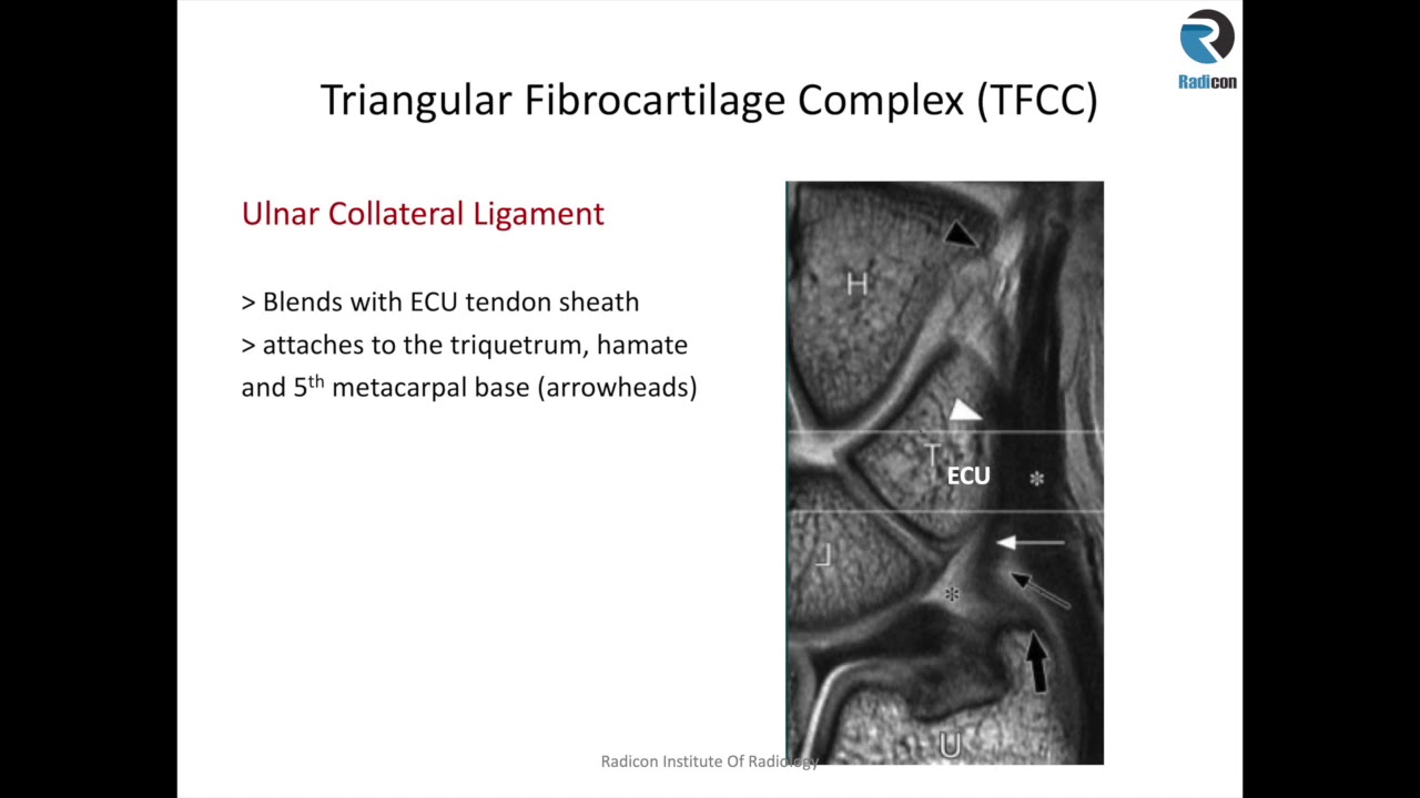 Wrist MRI Part 2: TFCC - YouTube