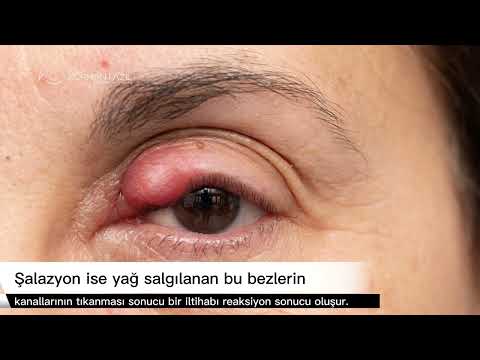 Arpacık ve Şalazyon  - Doc. Dr. Korhan Fazıl