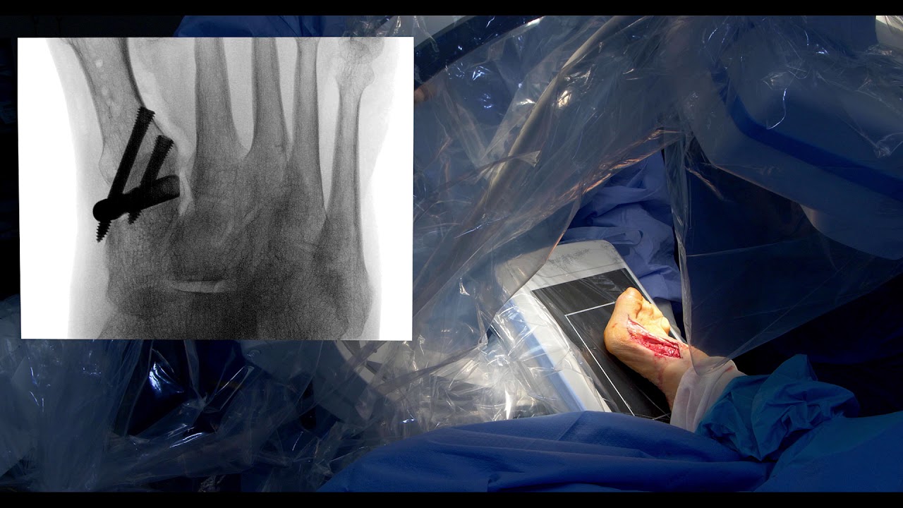 Lapidus Fusion Zimmer Biomet InCore (Dr. Econopouly) - YouTube