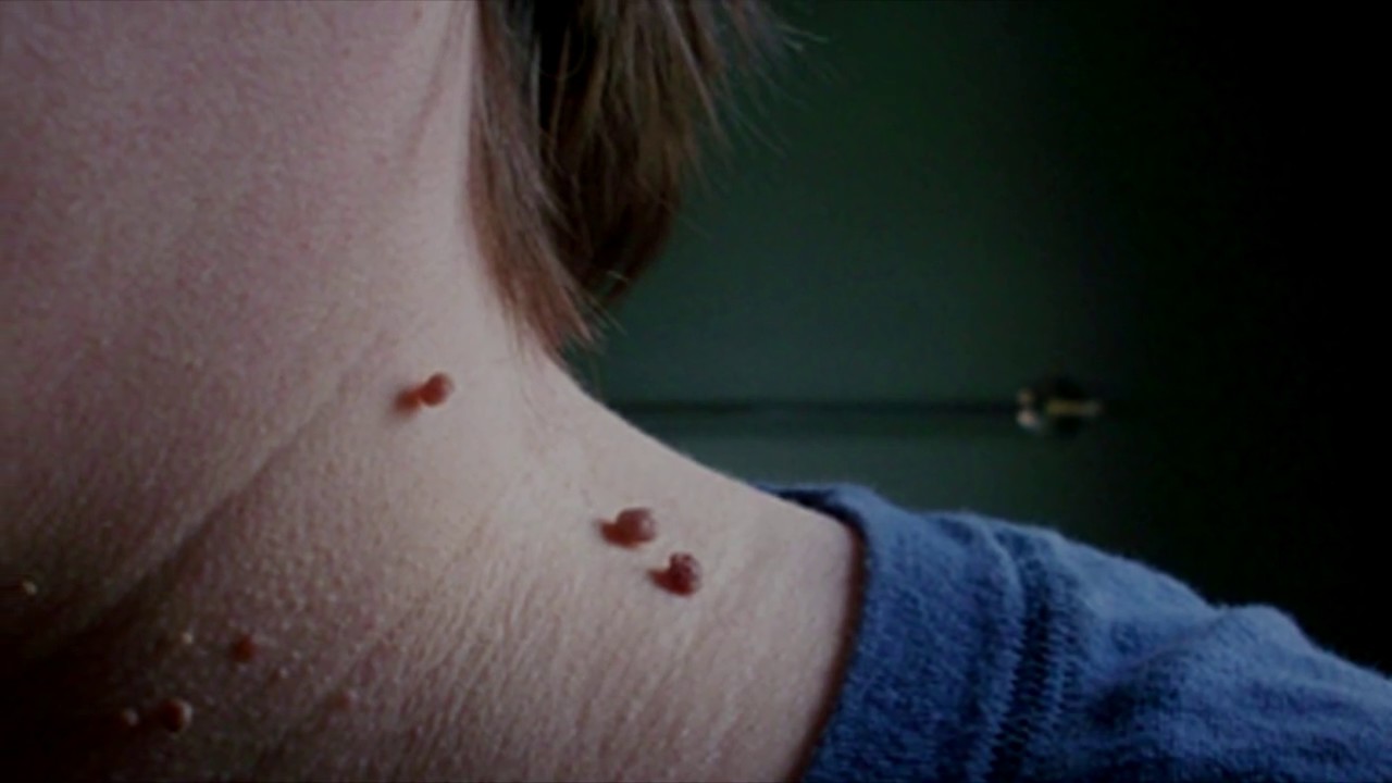 Remova Fibroma ou Verruga da Pele Usando um Único Ingrediente! - YouTube