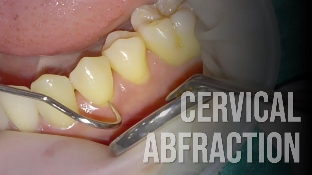 Class V Composite Restoration - YouTube