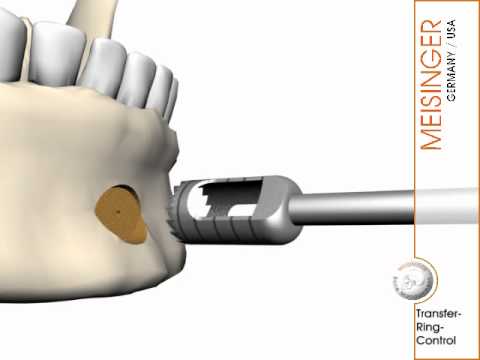 Transfer Ring Control - YouTube