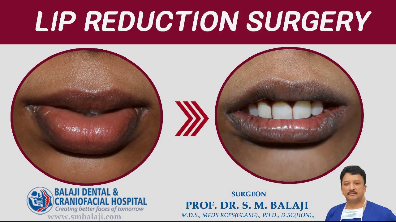 Lip Reduction Surgery - YouTube