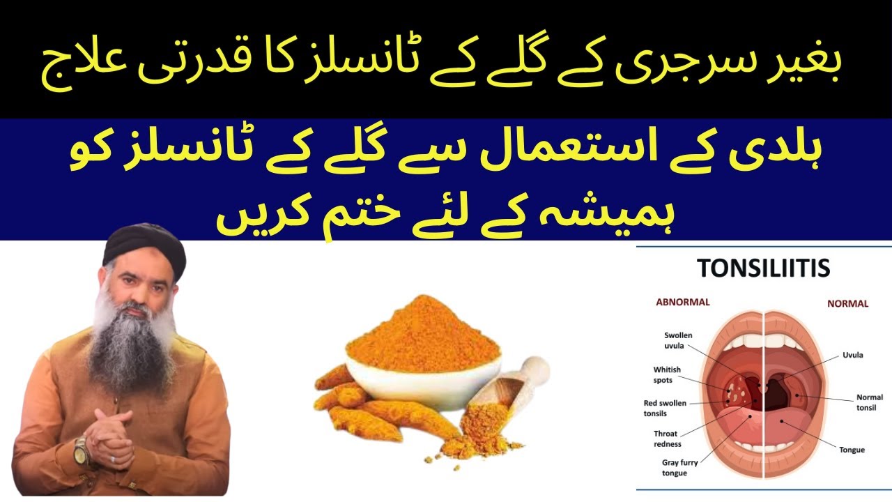 Gale Ke Tonsil Ka ilaj | Tonsillitis Ka Gharelu ilaj | Bagar Operation ...