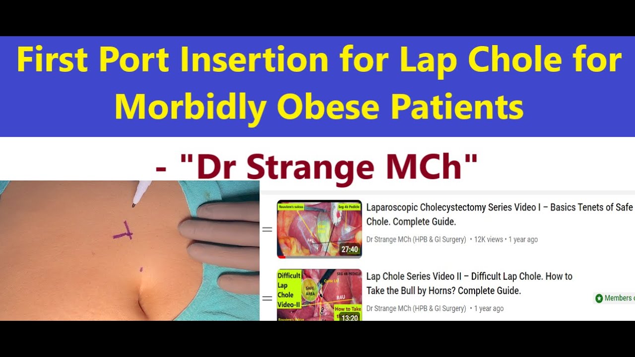 Mastering First Port Insertion for Lap Cholecystectomy in Morbidly ...