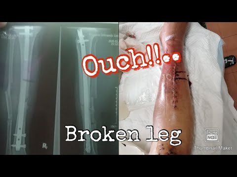 Broken leg recovery update 2019 - 2020 - YouTube