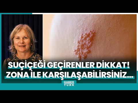 Küçükken suçiçeği geçirenler dikkat! Her an zona ile karşılaşabilirsiniz…