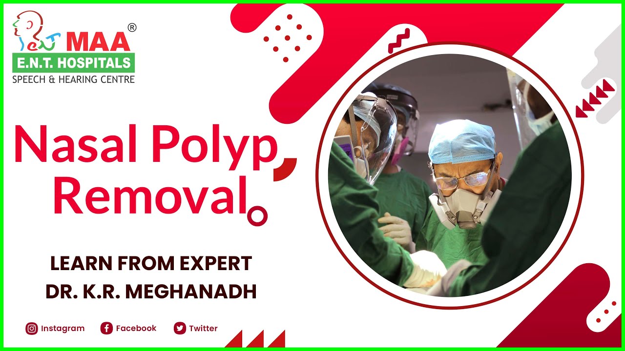 Nasal Polyp Removal | Sinus Surgery Performed Using Navigation ENT ...