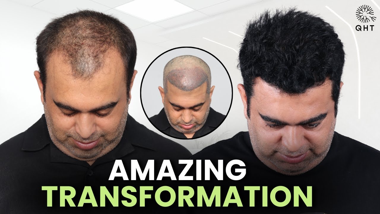 Diffuse Grade 3A Hair Transplant | Grade 3 Hair Transplant | Grade 3 ...
