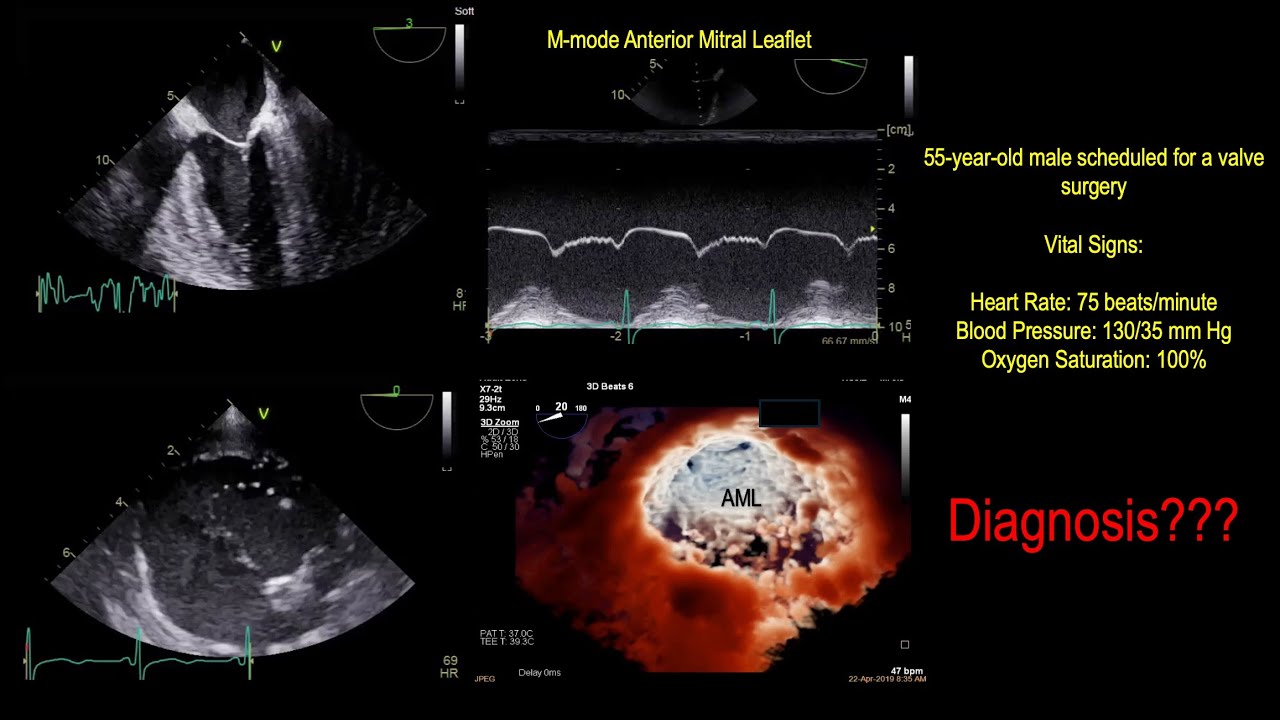 Echo Quiz: A fluttering mitral valve - YouTube