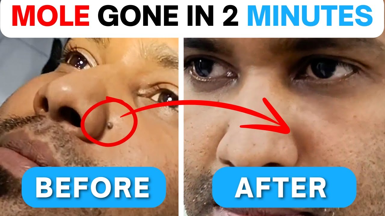 Remove Your SPOTS for A Natural Clear FACE with MOLE Removal Procedure ...