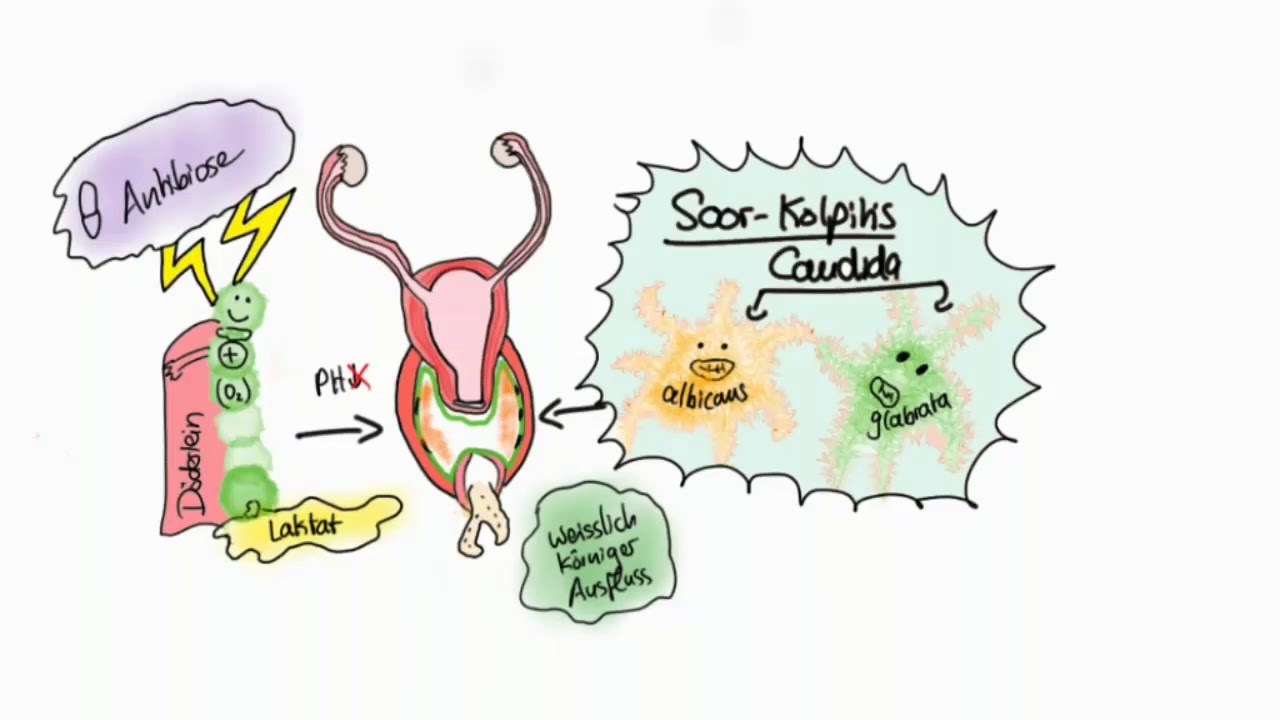 Soor Kolpitis 720p 30fps H264 192kbit AAC - YouTube