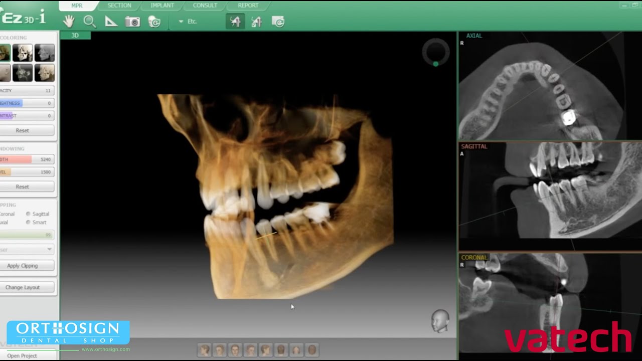 ¿Cómo se ven los Rayos X 3D Cone Beam? en Vatech A9 - Estudio 8.5 x 10 ...