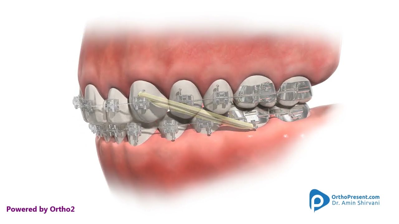 Elastics Class II - YouTube