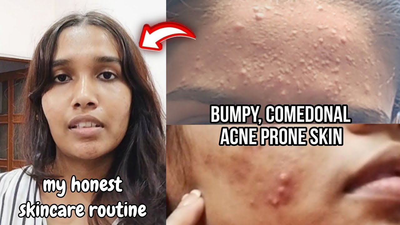 My honest Skincare Routine for Bumpy Comedonal Sensitive Acne-Prone ...